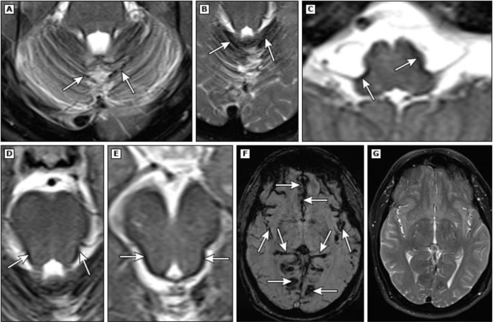 Siderosis superficial del sistema nervioso central - Wikimedicina